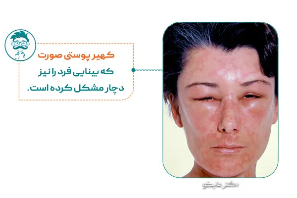 انواع کهیر پوستی چیست؟ علت، علائم، درمان عکس دکترمایکو