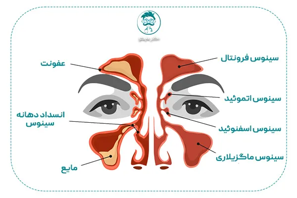 سینوزیت (عفونت سینوس‌ها) چیست؟ علت، علائم و درمان -دکترمایکو