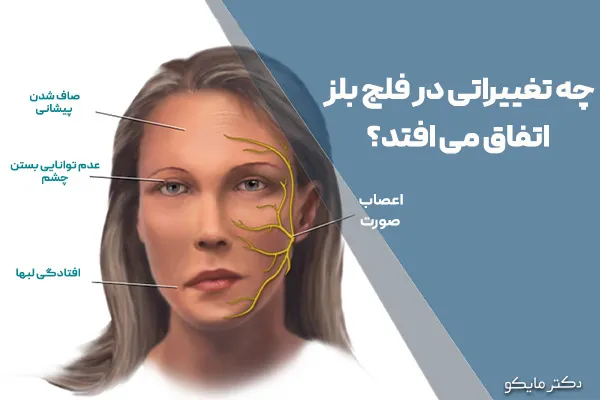 آیا فلج بلز خطرناک است؟ مدت زمان درمان قطعی فلج بلز + علل